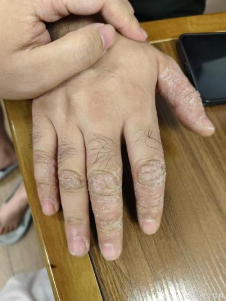 鹅掌风症状图片_鹅掌风初期长什么样-第2张图片-山城妙识