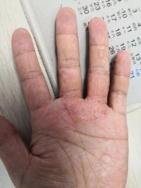 鹅掌风症状图片_鹅掌风初期长什么样-第3张图片-山城妙识