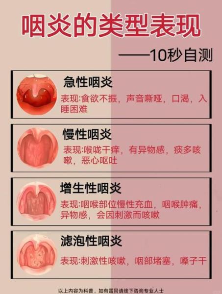 慢性咽炎的症状有哪些_如何判断得了慢性咽炎-第1张图片-山城妙识