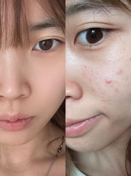 苦瓜汁敷脸可以祛痘吗_苦瓜汁祛痘效果怎么样-第3张图片-山城妙识 苦瓜汁敷脸可以祛痘吗_苦瓜汁祛痘效果怎么样-第3张图片-山城妙识