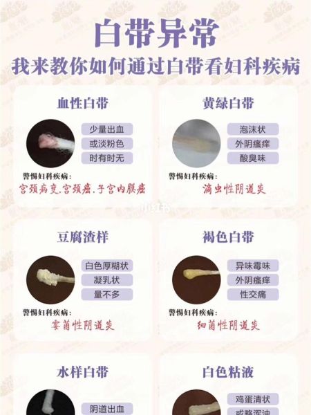 轻微豆腐渣样白带图片_是什么原因-第3张图片-山城妙识 轻微豆腐渣样白带图片_是什么原因-第3张图片-山城妙识