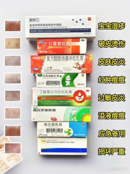 湿疹吃什么药最有效果_湿疹反复发作用什么药好-第1张图片-山城妙识