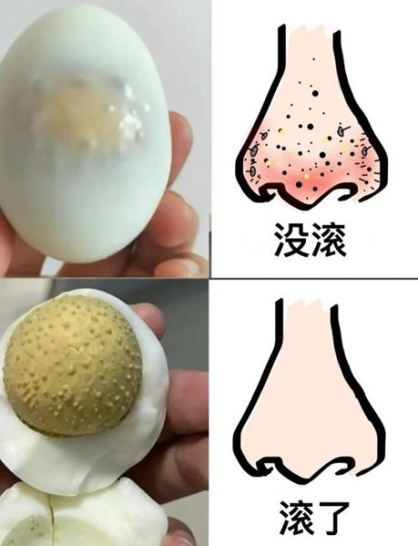 蛋清可以去黑头吗_蛋清去黑头有效吗-第1张图片-山城妙识