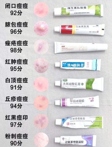 祛痘药膏哪个好_祛痘药膏排行榜10强-第1张图片-山城妙识