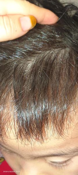 虱子怎么去除最快方法_虱子卵怎么彻底清除-第1张图片-山城妙识