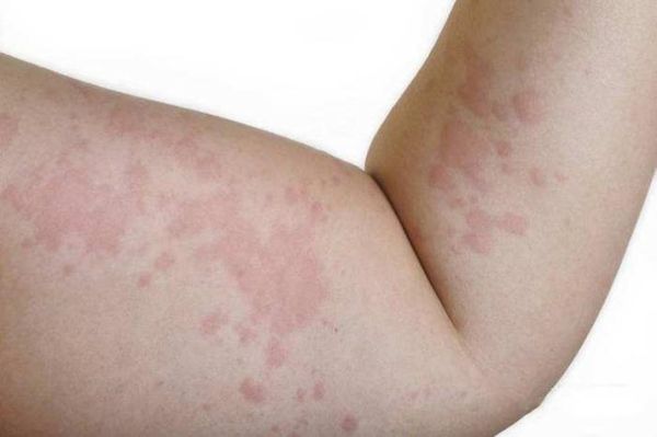 过敏图片怎么看_过敏症状图片识别方法-第3张图片-山城妙识 过敏图片怎么看_过敏症状图片识别方法-第3张图片-山城妙识