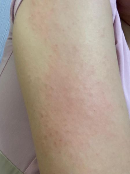 过敏图片怎么看_过敏症状图片识别方法-第1张图片-山城妙识 过敏图片怎么看_过敏症状图片识别方法-第1张图片-山城妙识