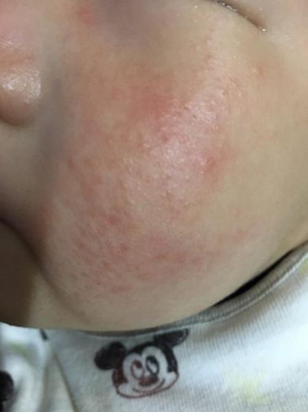 过敏图片怎么看_过敏症状图片识别方法-第2张图片-山城妙识 过敏图片怎么看_过敏症状图片识别方法-第2张图片-山城妙识