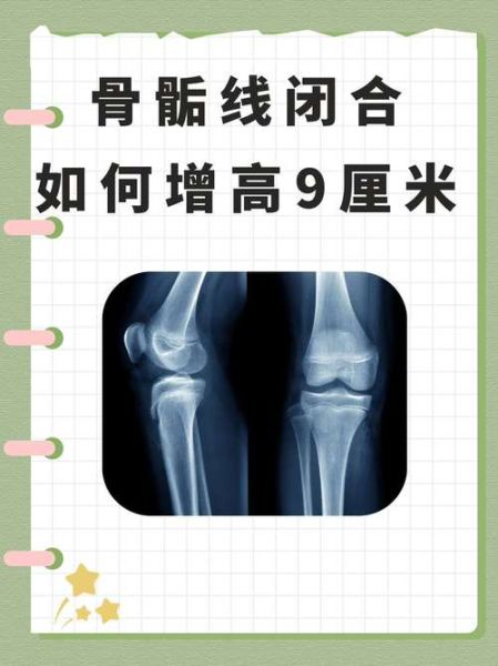 骨骺线闭合还能长高吗_骨骺线闭合增高9厘米是真的吗-第1张图片-山城妙识