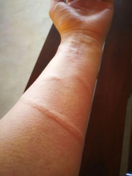 轻度水母蛰了伤口图片_怎么处理不留疤-第3张图片-山城妙识