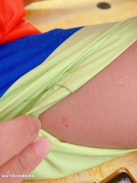 轻度水母蛰了伤口图片_怎么处理不留疤-第1张图片-山城妙识