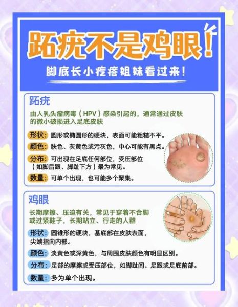 鸡眼和跖疣的区别图_如何快速区分-第1张图片-山城妙识 鸡眼和跖疣的区别图_如何快速区分-第1张图片-山城妙识