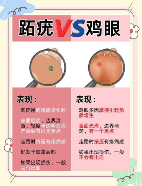 鸡眼和跖疣的区别图_如何快速区分-第2张图片-山城妙识 鸡眼和跖疣的区别图_如何快速区分-第2张图片-山城妙识