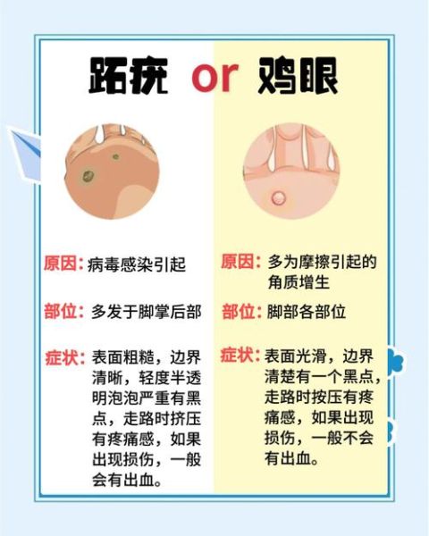 鸡眼和跖疣的区别图_如何快速区分-第3张图片-山城妙识 鸡眼和跖疣的区别图_如何快速区分-第3张图片-山城妙识