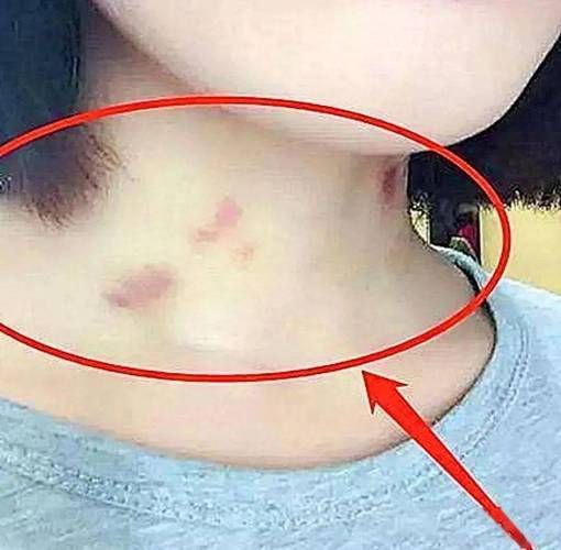 草莓印怎么吸_草莓印多久能消-第1张图片-山城妙识 草莓印怎么吸_草莓印多久能消-第1张图片-山城妙识