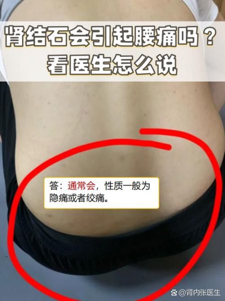 女人得了肾结石就废了_真的吗-第3张图片-山城妙识