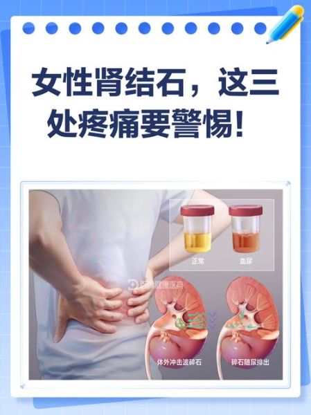 女人得了肾结石就废了_真的吗-第2张图片-山城妙识