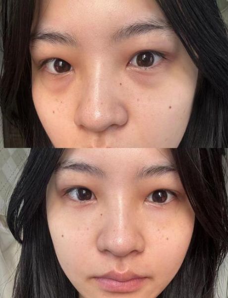 吃什么可以消除黑眼圈_黑眼圈吃什么最快见效-第3张图片-山城妙识