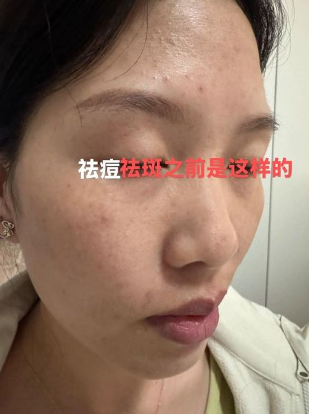 祛斑最有效的方法是什么_激光祛斑会反弹吗-第2张图片-山城妙识