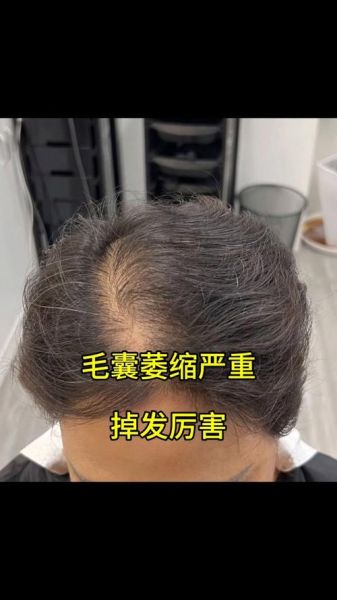 怎样激活毛囊长出新发_毛囊萎缩还能恢复吗-第2张图片-山城妙识 怎样激活毛囊长出新发_毛囊萎缩还能恢复吗-第2张图片-山城妙识