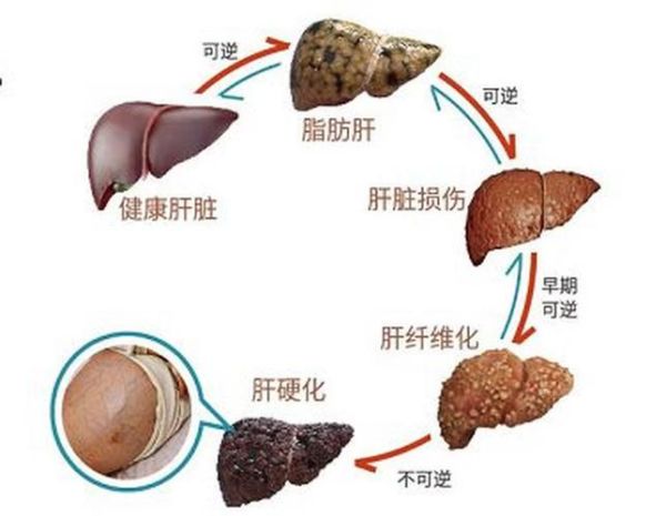 早期肝硬化能逆转吗_肝纤维化怎么软化回来-第1张图片-山城妙识