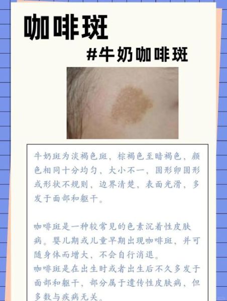牛奶咖啡斑长什么样_牛奶咖啡斑和胎记区别-第1张图片-山城妙识 牛奶咖啡斑长什么样_牛奶咖啡斑和胎记区别-第1张图片-山城妙识