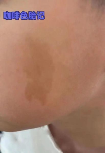 牛奶咖啡斑长什么样_牛奶咖啡斑和胎记区别-第3张图片-山城妙识 牛奶咖啡斑长什么样_牛奶咖啡斑和胎记区别-第3张图片-山城妙识