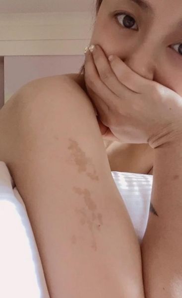 牛奶咖啡斑长什么样_牛奶咖啡斑和胎记区别-第2张图片-山城妙识 牛奶咖啡斑长什么样_牛奶咖啡斑和胎记区别-第2张图片-山城妙识