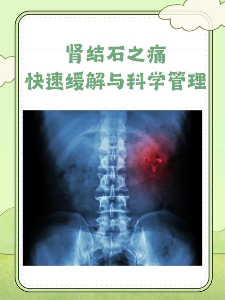 肾结石发作一般痛几天_如何缓解-第3张图片-山城妙识