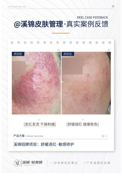 皮肤过敏自己会恢复吗_多久能好-第3张图片-山城妙识