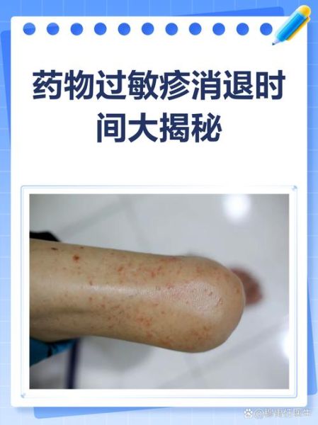 皮肤过敏自己会恢复吗_多久能好-第1张图片-山城妙识