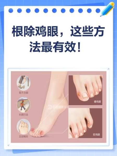 鸡眼怎么根治_鸡眼贴多久能好-第3张图片-山城妙识