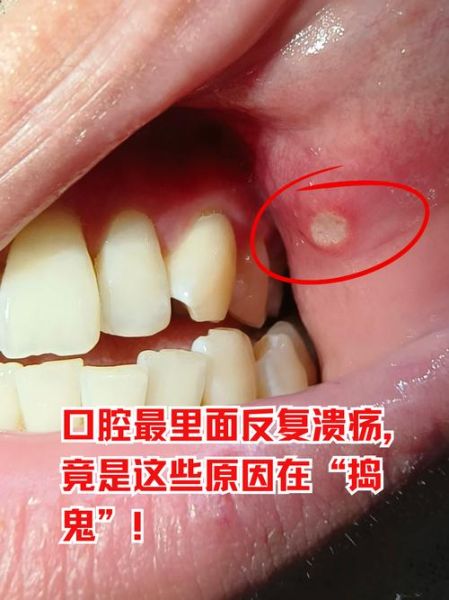 口腔溃疡长什么样_怎么判断是不是口腔溃疡-第1张图片-山城妙识