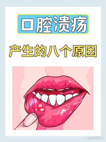 口腔溃疡长什么样_怎么判断是不是口腔溃疡-第2张图片-山城妙识