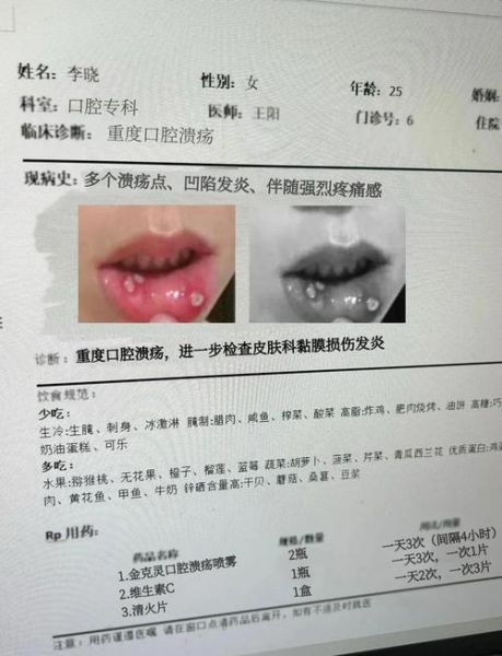 口腔溃疡长什么样_怎么判断是不是口腔溃疡-第3张图片-山城妙识