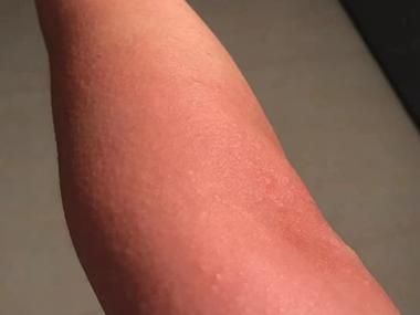 海鲜过敏症状怎么办_紧急处理步骤-第3张图片-山城妙识