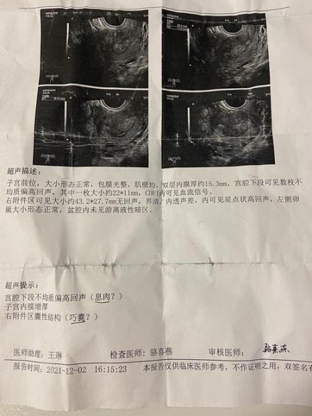 巧克力囊肿术后多久能怀孕_术后怀孕最佳时间-第3张图片-山城妙识