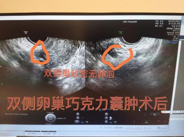 巧克力囊肿术后多久能怀孕_术后怀孕最佳时间-第2张图片-山城妙识