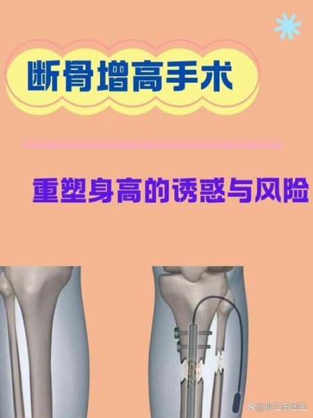 增高手术后遗症有哪些_增高手术风险大吗-第2张图片-山城妙识 增高手术后遗症有哪些_增高手术风险大吗-第2张图片-山城妙识