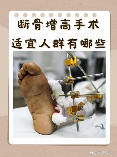 增高手术后遗症有哪些_增高手术风险大吗-第1张图片-山城妙识 增高手术后遗症有哪些_增高手术风险大吗-第1张图片-山城妙识