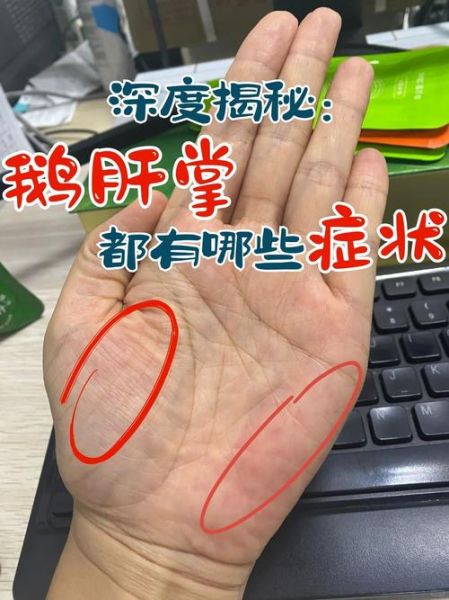 肝有病最明显的症状_肝病早期有哪些表现-第2张图片-山城妙识 肝有病最明显的症状_肝病早期有哪些表现-第2张图片-山城妙识