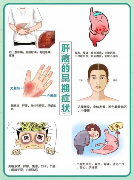 肝有病最明显的症状_肝病早期有哪些表现-第1张图片-山城妙识 肝有病最明显的症状_肝病早期有哪些表现-第1张图片-山城妙识