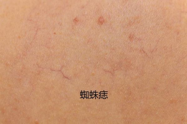 肝有病最明显的症状_肝病早期有哪些表现-第3张图片-山城妙识 肝有病最明显的症状_肝病早期有哪些表现-第3张图片-山城妙识