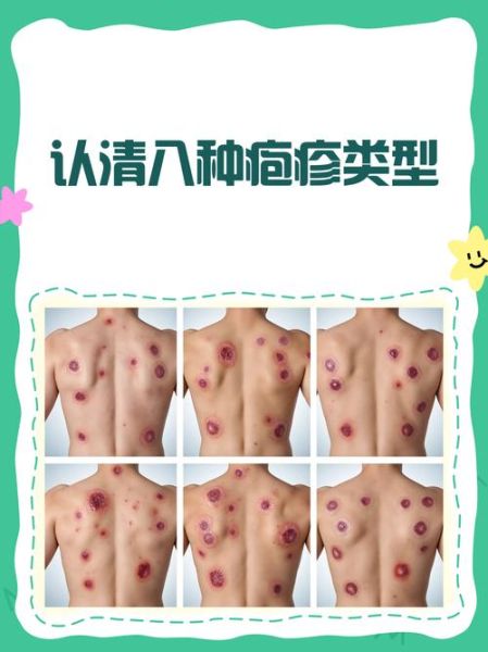 水泡和疱疹的区别图片_怎么区分-第3张图片-山城妙识 水泡和疱疹的区别图片_怎么区分-第3张图片-山城妙识