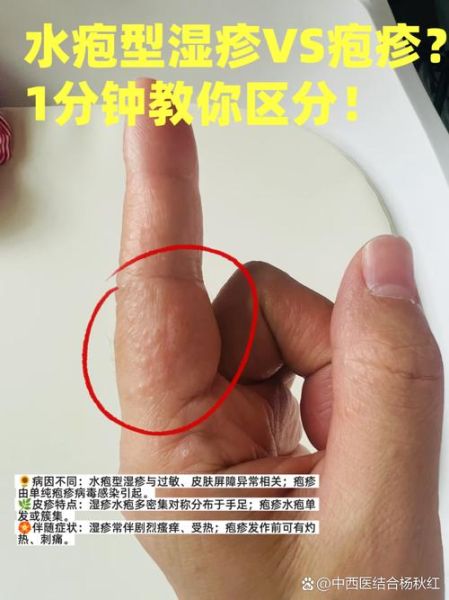 水泡和疱疹的区别图片_怎么区分-第2张图片-山城妙识 水泡和疱疹的区别图片_怎么区分-第2张图片-山城妙识