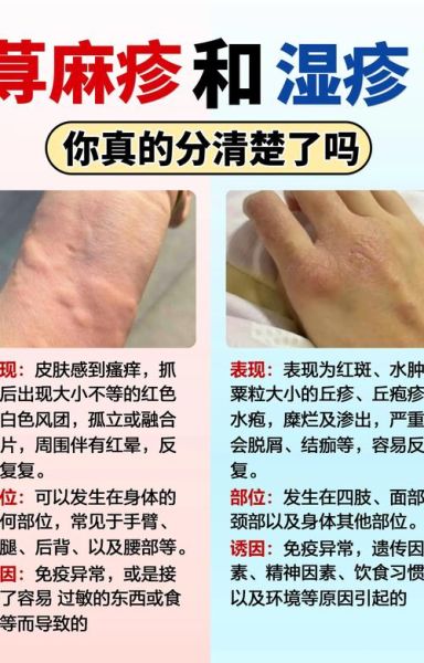 身上起红疙瘩越挠越痒_怎么办-第3张图片-山城妙识 身上起红疙瘩越挠越痒_怎么办-第3张图片-山城妙识