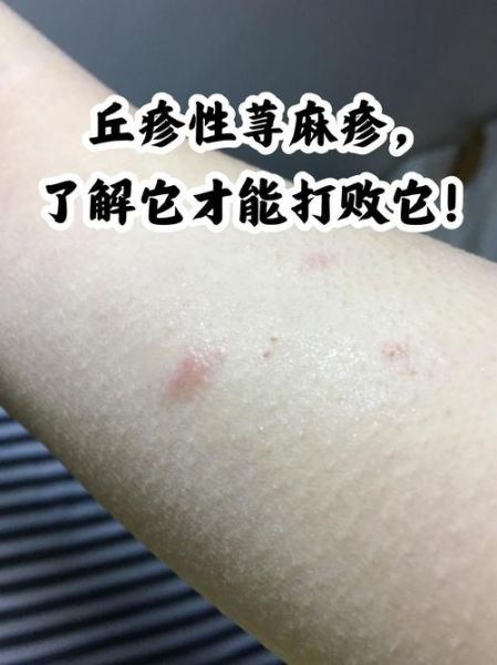 荨麻疹可以自愈吗_荨麻疹多久能好-第3张图片-山城妙识 荨麻疹可以自愈吗_荨麻疹多久能好-第3张图片-山城妙识