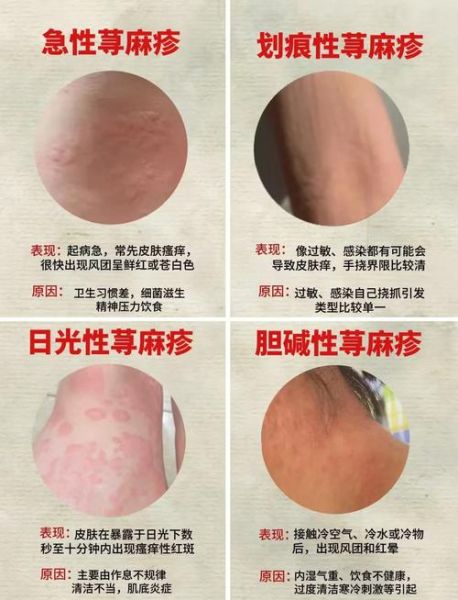 荨麻疹可以自愈吗_荨麻疹多久能好-第1张图片-山城妙识 荨麻疹可以自愈吗_荨麻疹多久能好-第1张图片-山城妙识