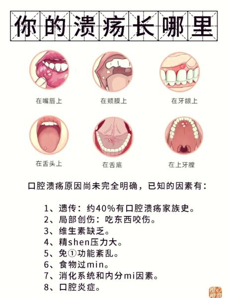 儿童口腔溃疡怎么办_家庭快速缓解方法-第1张图片-山城妙识 儿童口腔溃疡怎么办_家庭快速缓解方法-第1张图片-山城妙识