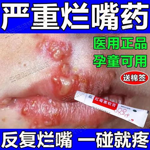 嘴角起泡用红霉素软膏有用吗_嘴角起泡怎么办-第3张图片-山城妙识 嘴角起泡用红霉素软膏有用吗_嘴角起泡怎么办-第3张图片-山城妙识